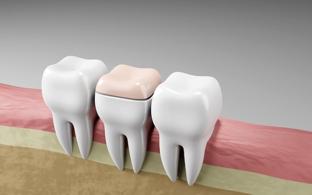Dental Inlays and Onlays in Kolkata
